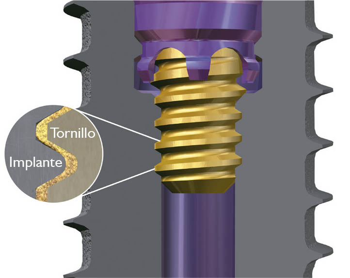 Gold-Tite® – Dentalmax SA
