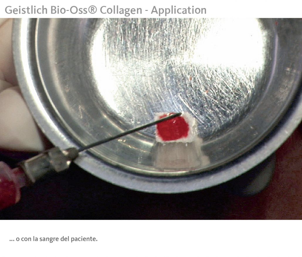 Geistlich Bio-Oss® Collagen – Dentalmax SA