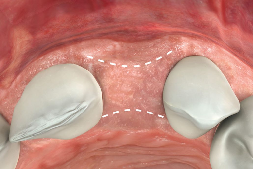 Geistlich Bio-Gide® Shape – Dentalmax SA