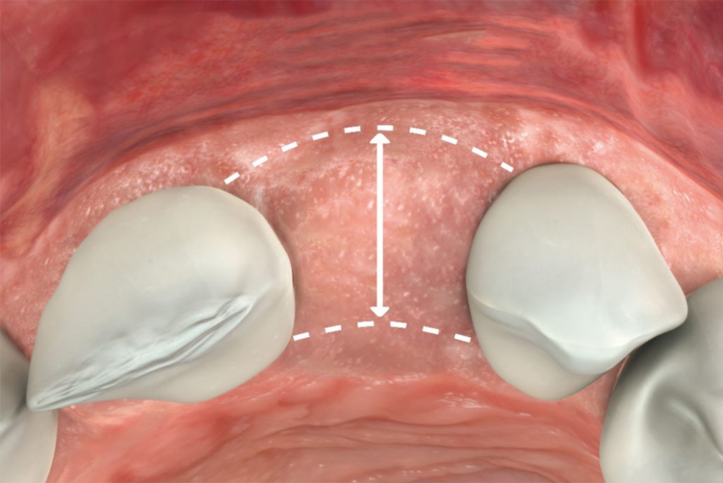 Geistlich Bio-Gide® Shape – Dentalmax SA